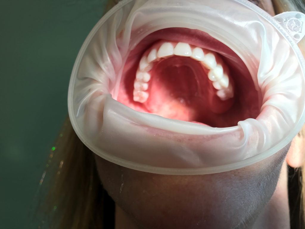 The Role of Saliva in Denture Use and Maintenance - Woodside Denture Centre