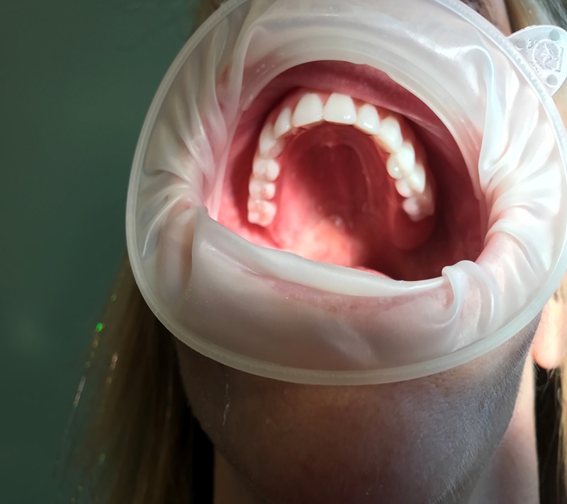 How Many Implants Needed for Implant Dentures? - Woodside Denture Centre